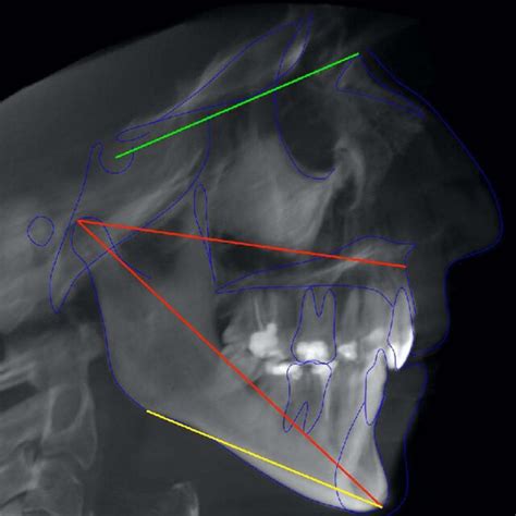 Archer L Classification Of Upper Third Molars A Type A B Type B