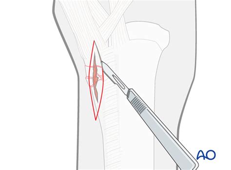 Approaches To The Splint Bones