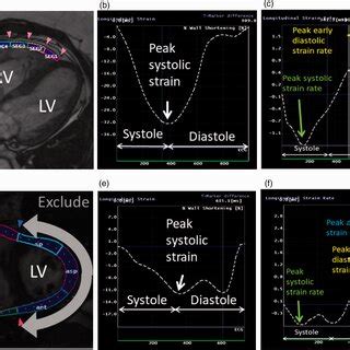 A Representative Image Of Right Ventricular RV Longitudinal Peak Download Scientific