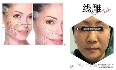 液态线雕到底是何方神圣？（一） 知乎