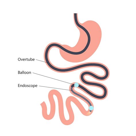 Duodenum Illustration Vectors And Illustrations For Free Download