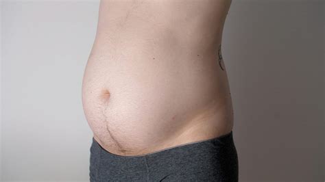 Removing A Beer Belly With Liposuction Does It Work Airsculpt
