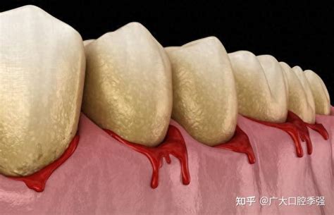 牙齿松动、敏感、牙龈出血，这可能是牙周病，千万不能拖！ 知乎