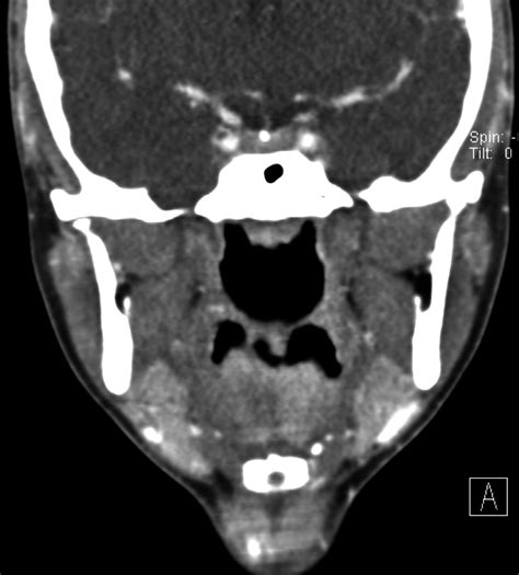 Idiopathic Mandibular Condyle Resorption Pmc