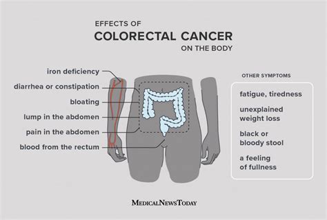 Colorectal Cancer Symptoms Treatment Risk Factors And More Project