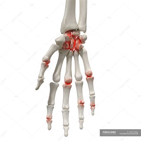 Realistic Digital Illustration Showing Arthritis In Human Hand