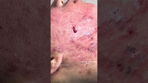 Ca Mụn Bọc Mụn đầu Trắng Dermatologist Treating Squeeze Pimples