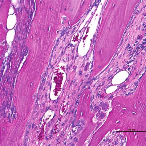 Chronic Enteritis Lymphoplasmacytic Inflammation Expanding The Jejunum Download Scientific