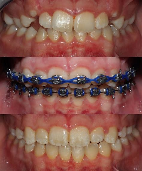 Navy Blue Braces Rubber Bands At Ellie Dow Blog