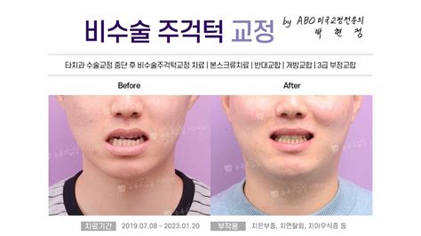 주걱턱재교정 비수술주걱턱교정타치과 수술교정 중단 후 비수술주걱턱교정 치료본스크류치료반대교합개방교합3급부정교합 B