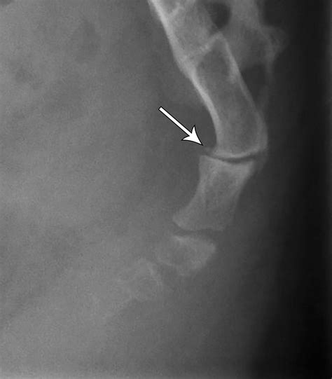 Coccyx X Ray Labeled At Juliette Bailey Blog