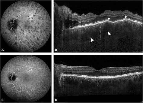 Choroidal Granuloma Associated With Vogt Koyanagi Haradas Disease Download Scientific Diagram