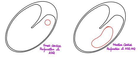 How To Draw Tympanic Membrane Perforations Ent Notes And Lectures