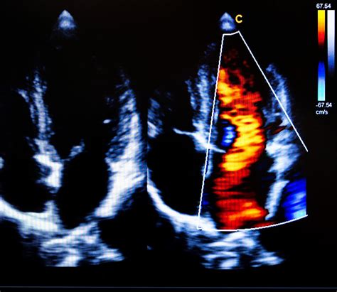 Abnormal Echocardiogram