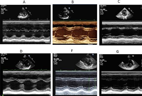 M Mode At Parasternal Short Axis Follow Up Pattern Of Interventricular