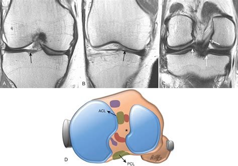 Imaging Of The Meniscus Clinical Tree