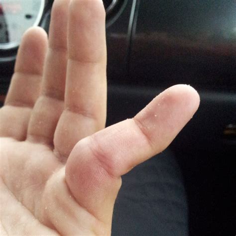 Crooked Finger Finger Dislocations Welcome To Orthopedics Fiesta
