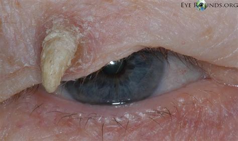 Verruca Vulgaris Eyelid Pediatric Eyelid Cutaneous Horns A Case