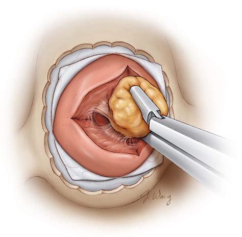 Pituitary Microadenoma The Neurosurgical Atlas
