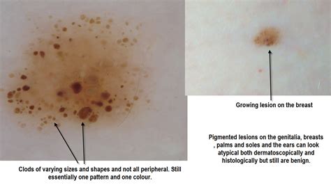 Dermoscopy Made Simple Benign Nevus