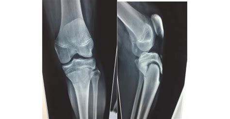 Proximal Tibial Epiphysis Fracture In A Male Athlete Medsynapse