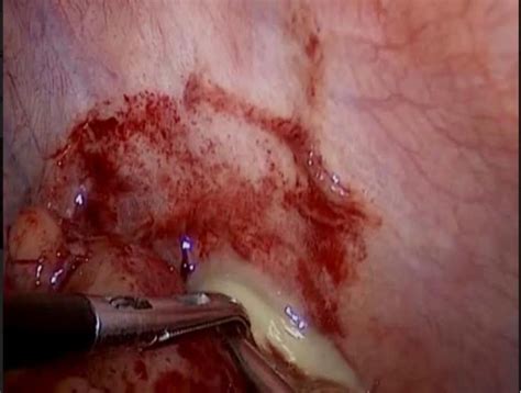 Laparoscopic Management Of Appendicular Lump Semantic Scholar