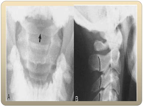 Congenital Anomalies And Normal Skeletal Variants Cervical Spine Ppt