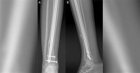 Tibia Fracture