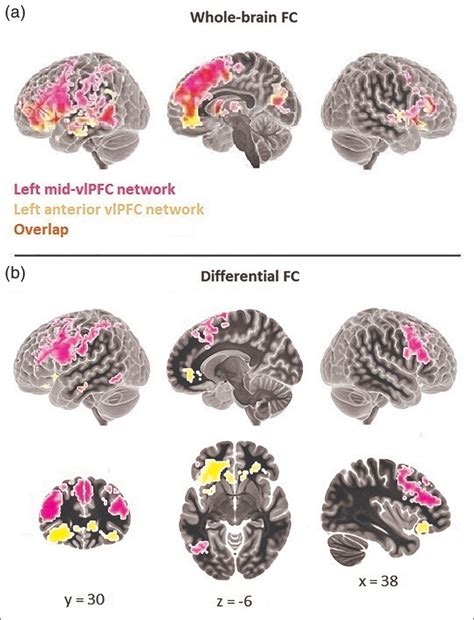 A Whole‐brain Functional Connectivity Fc For Left Mid‐ventrolateral Download Scientific