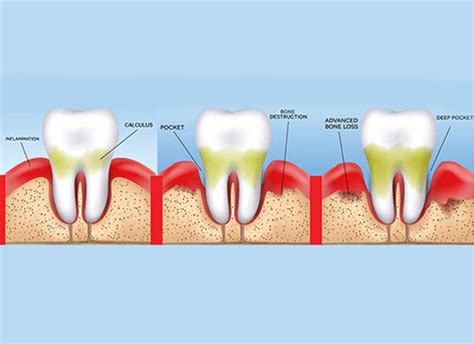 Plaque Calculus Tartar Gum Disease Pinewood Dental