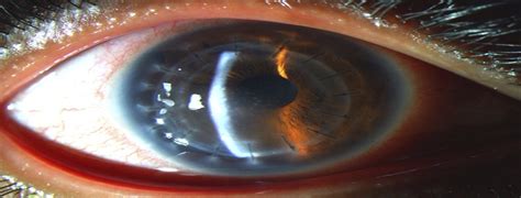 Microsporidial Stromal Keratitis Masquerading As Acute Graft Cornea