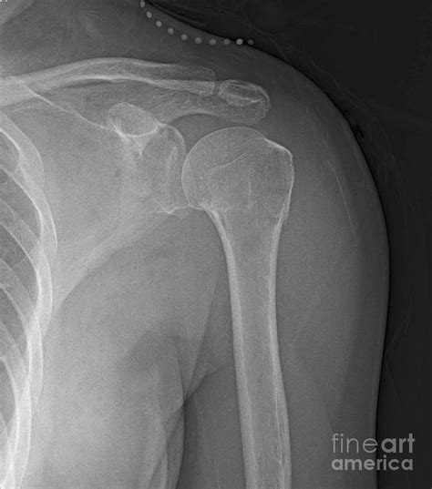 Humerus Fracture 11 Photograph By Rajaaisyascience Photo Library Humerus Fracture 11 Photograph By Rajaaisyascience Photo Library