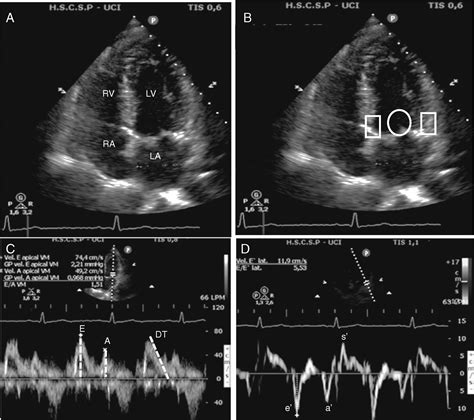 Diastolic Dysfunction In The Critically Ill Patient Medicina Intensiva