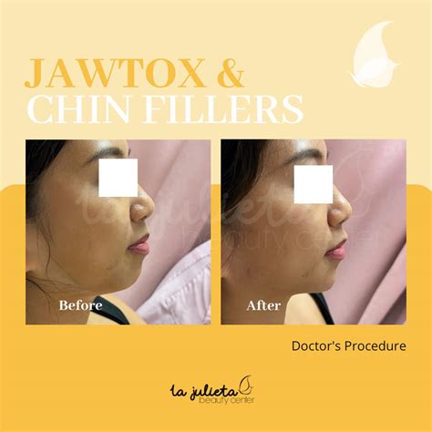Jawtox And Chin La Julieta Beauty Center Parañaque