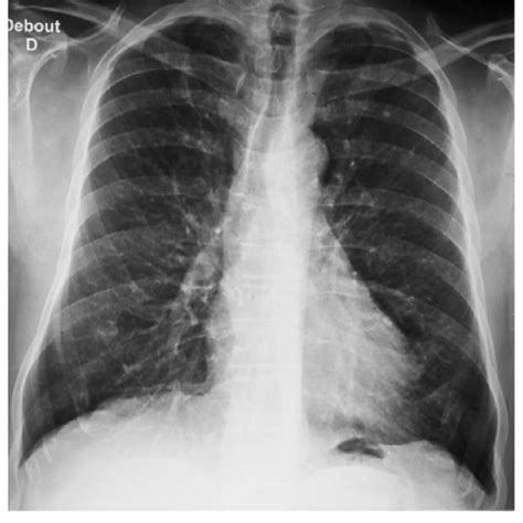 A Plain Radiograph Of Left Hand Shows Marginal Erosions Of Triquetrum
