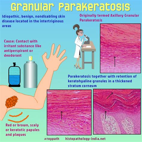 Sebaceous Cyst Icd 10 KeontuHobbs