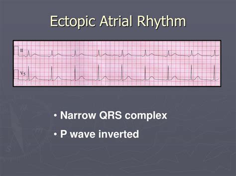 Meaning Of Ventricular Ectopy At Betty Love Blog