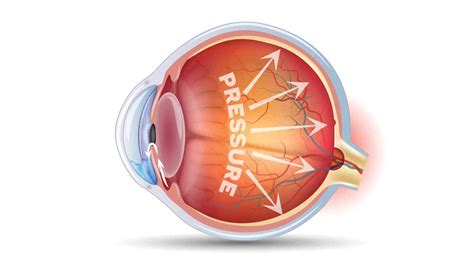 Glaucoma Treatments Coming Down The Pipeline Ophthalmology Management
