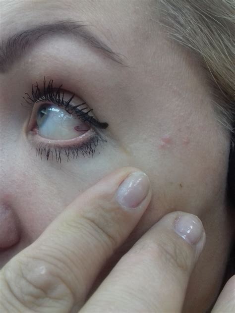 Червь в глазу Вопрос офтальмологу 03 Онлайн