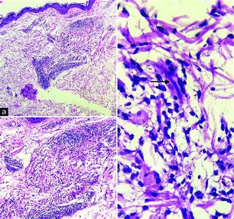 A Histopathological Examination Shows Thinned Out Atrophic Epidermis