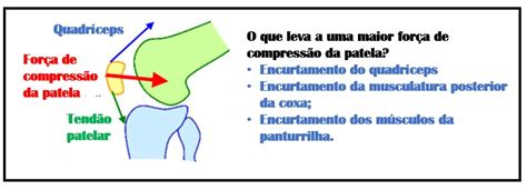 Condromalácia Patelar Joelho Medicina de Excelência