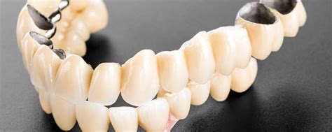 comparison between temporary vs permanent dental bridge