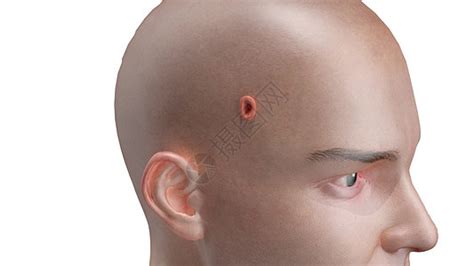 皮肤鳞状细胞癌一期 鳞状细胞癌图片素材 正版创意图片402181604 摄图网