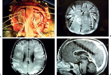 21 Extratemporal Resection Neupsy Key