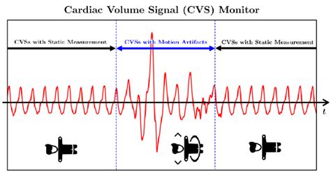 Motion Induced Artifacts In Cardiac Volume Monitoring Using Electrical