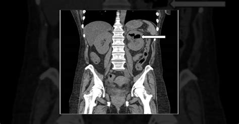 A Multidisciplinary Approach To Corynebacterium Emphysematous Pyelitis Medsynapse