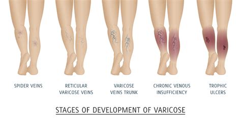 Venous Insufficiency Causes And Treatments For All Ages