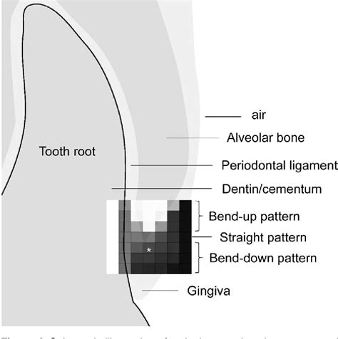Figure 4 From The Usefulness Of Cone Beam Computed Tomography Gray