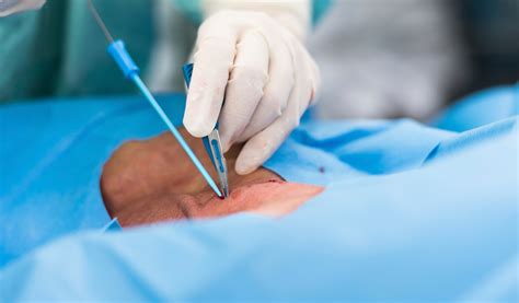 Implications For Ultrasound Guided Vascular Access Via Cannulation
