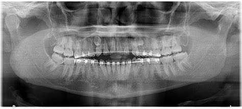 Supernumerary Teeth Extraction Raskdentists